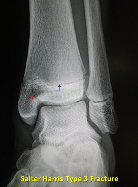 Salter-Harris Fracture Classification | National University Of Health ...